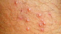 Saiba mais sobre foliculite - Dra. Vanessa Nobrega